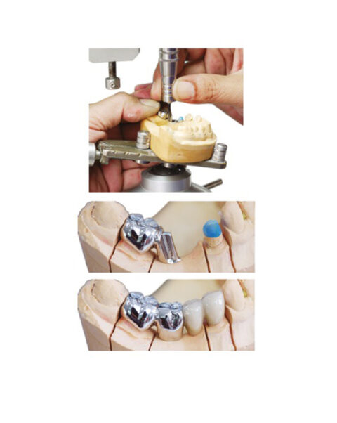 Attachment - Western Dental Laboratory