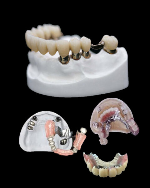 Telescopic - Western Dental Laboratory